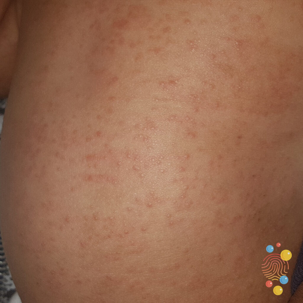 Viral Rash