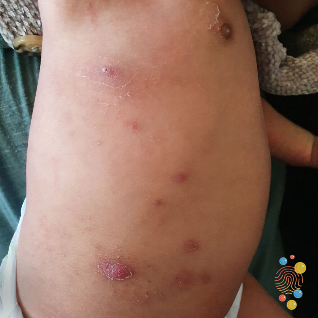 Abscess Skin Deep Abscess Skin Deep