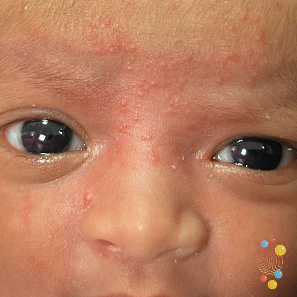 Toxic Erythema Of Newborn Treatment Infoupdate Toxic Erythema Of Newborn Treatment Infoupdate